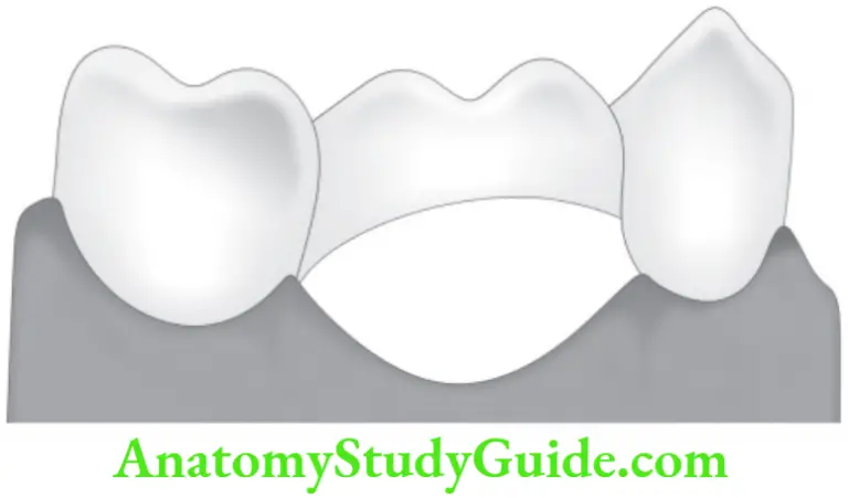 Pontics Design in Fixed Partial Denture - Anatomy Study Guide