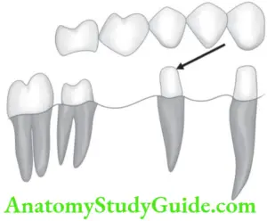 Cantilever Fixed Partial Denture - Anatomy Study Guide