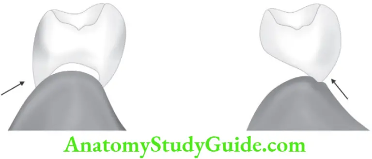 Pontics Design in Fixed Partial Denture - Anatomy Study Guide