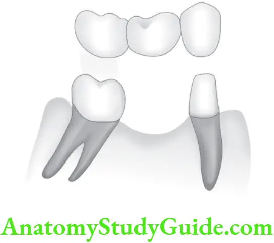 Treating Tilted Molars Question And Answers - Anatomy Study Guide