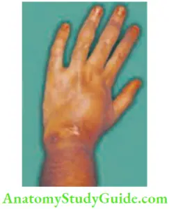 Epidermoid cysts - Symptoms and causes - Anatomy Study Guide