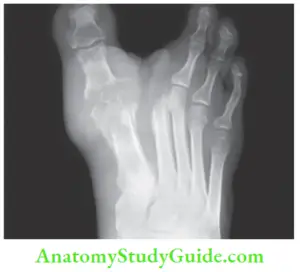 Differential Diagnosis Of Leg Bazin's Ulcer And Pressure Sore Notes ...