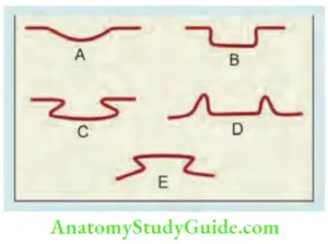 Differential Diagnosis Of Leg Bazin's Ulcer And Pressure Sore Notes ...