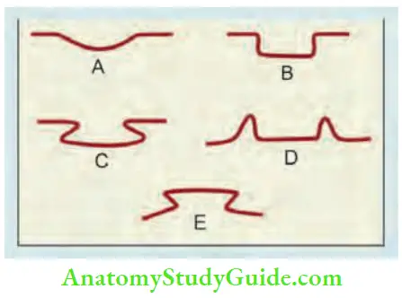 Differential Diagnosis Of Leg Bazin's Ulcer And Pressure Sore Notes ...