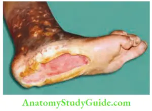 Differential Diagnosis Of Leg Bazin's Ulcer And Pressure Sore Notes ...