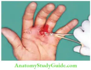 Tendon Transfer Surgery: Risks & Benefits - Anatomy Study Guide