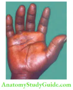 Tendon Transfer Surgery: Risks & Benefits - Anatomy Study Guide