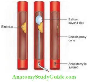 Acute Limb Ischaemia Notes - Anatomy Study Guide