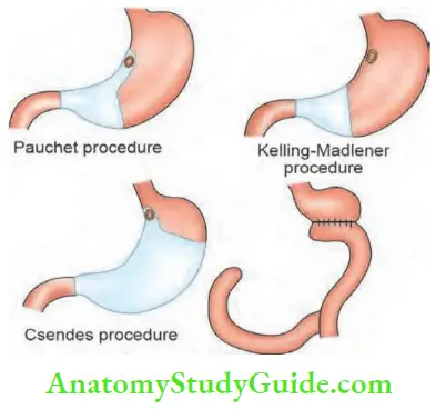 Peptic Ulcer Disease Types, Causes, Treatment - Anatomy Study Guide
