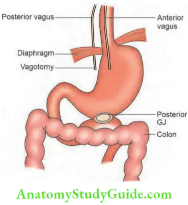 Laparoscopic Posterior Truncal Vagotomy And Anterior