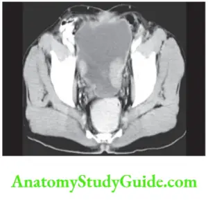 Urinary And Urethra Tract Infection Interstitial Cystitis Of The ...