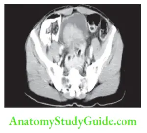 Urinary And Urethra Tract Infection Interstitial Cystitis Of The ...