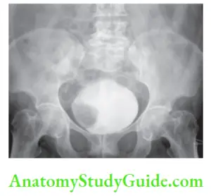 Urinary And Urethra Tract Infection Interstitial Cystitis Of The ...